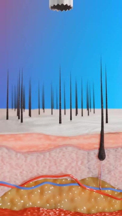 Hair transplant tutorial - Meme by X03ax :) Memedroid